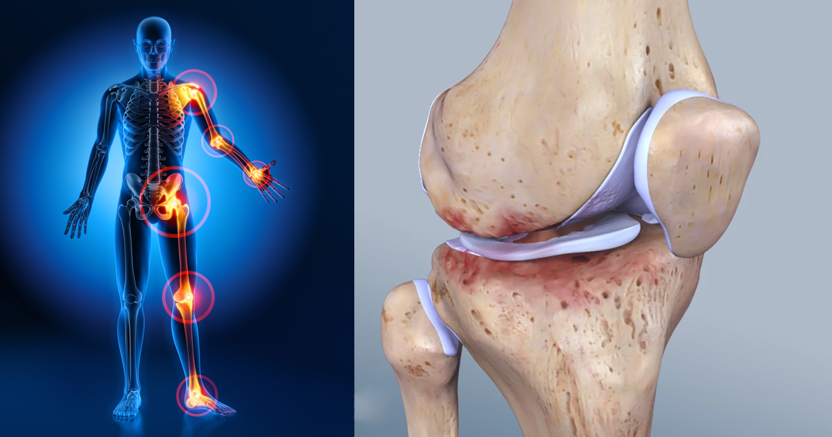 6 sfaturi pentru prevenirea osteoartritei după vârsta de 35 de ani